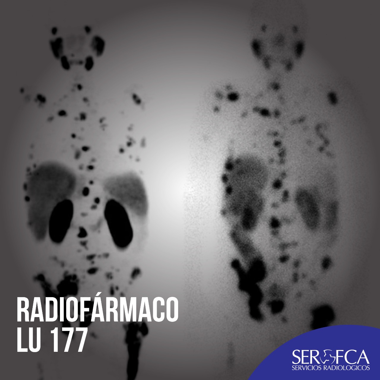 Radiofármacos Lu 177-DOTATATE – SEROFCA